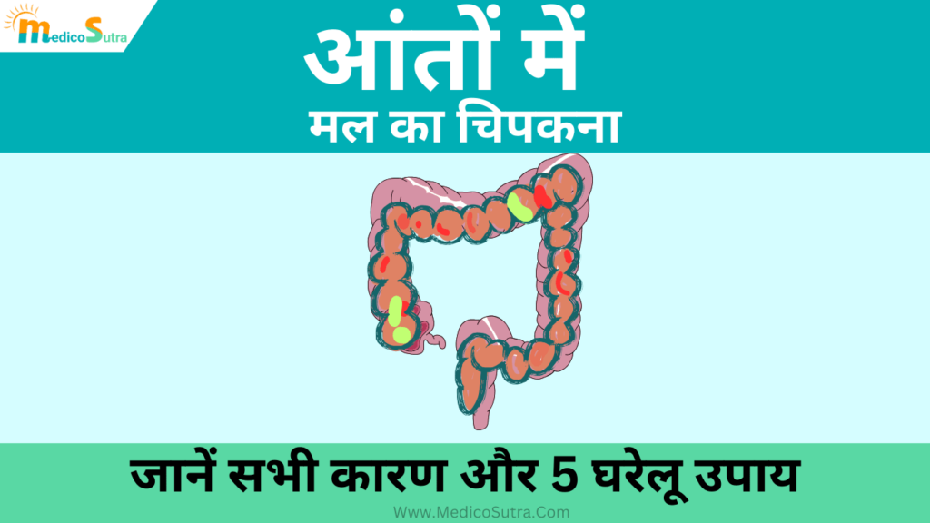 आंतों में मल का चिपकना; जानें सभी कारण और 5 घरेलू उपाय, Aanto Me Mal Ka ...